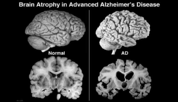 Νόσος Alzheimer: Συμπτώματα, Παθολογία και Νευροαπεικόνιση
